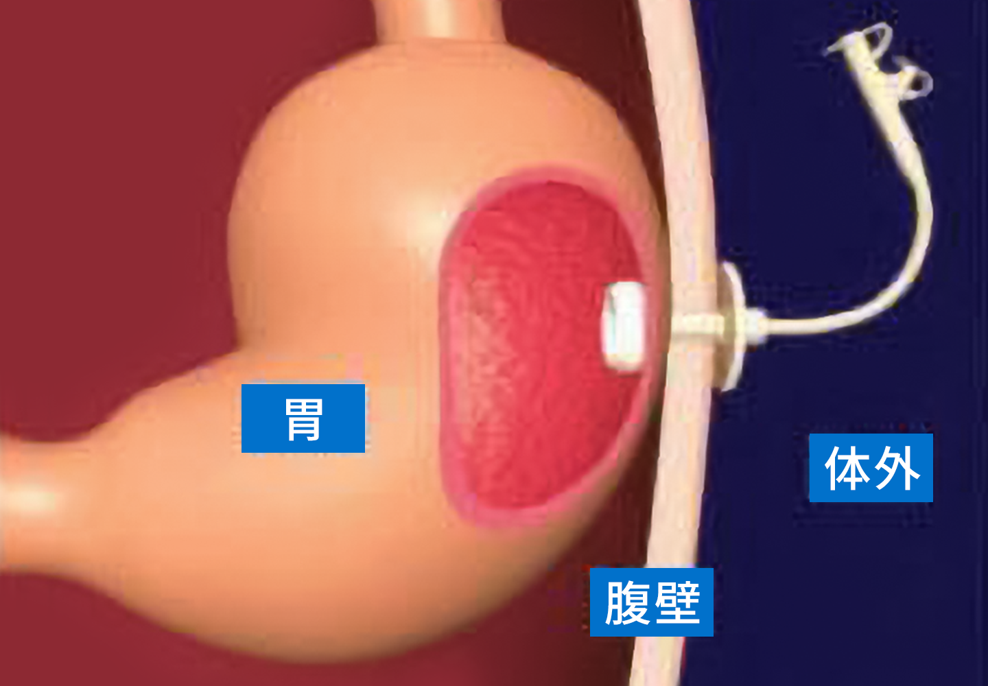 PTEG(ピーテグ)～胃瘻(いろう)造設困難な患者さんに対する栄養管理法～｜大分県立病院ニュース｜大分県立病院ブログ｜大分県立病院